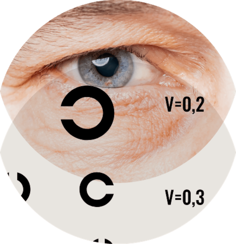 Ooglid­correctie - Oculux Oogcentrum